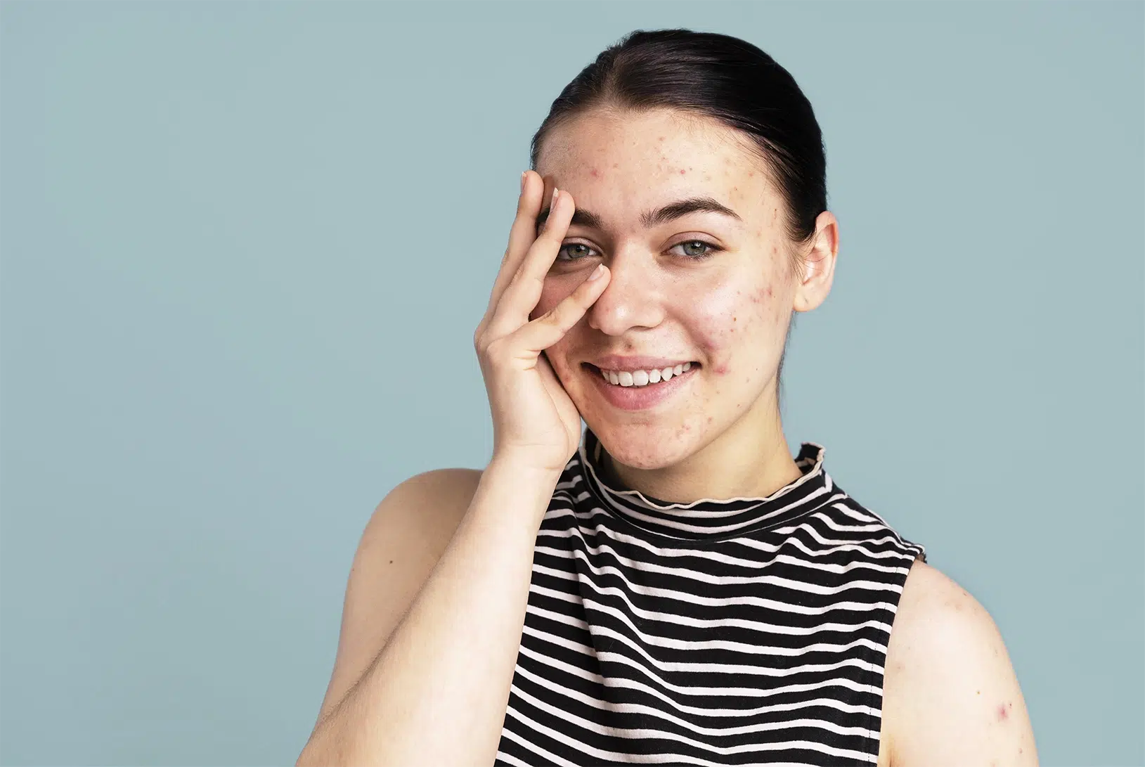 Traitements contre l’Acné : Soins rapides et efficaces