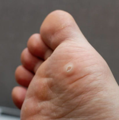 Verrues chez l’enfant : causes, traitement et prévention